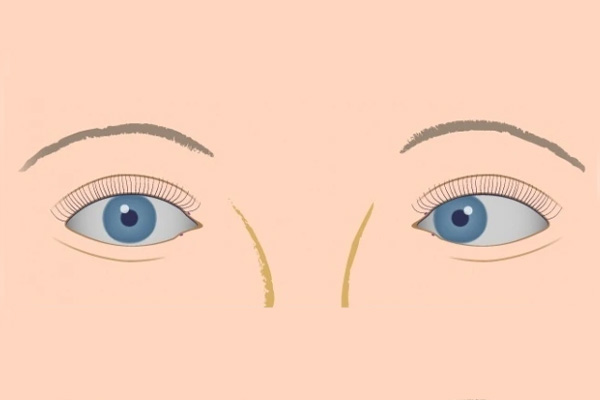 Šilhání - strabismus - Optikplus.cz